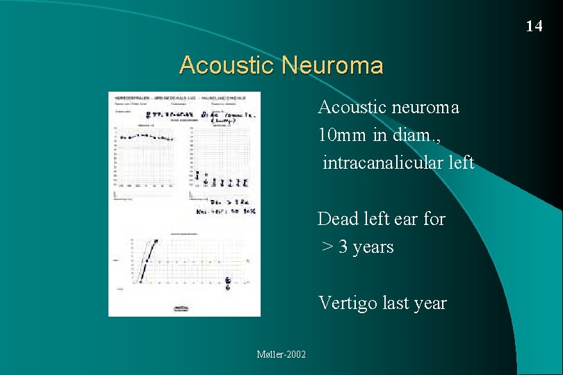 Acoustic Neuroma Vestibular Schwannoma Diagnosis and treatment Per