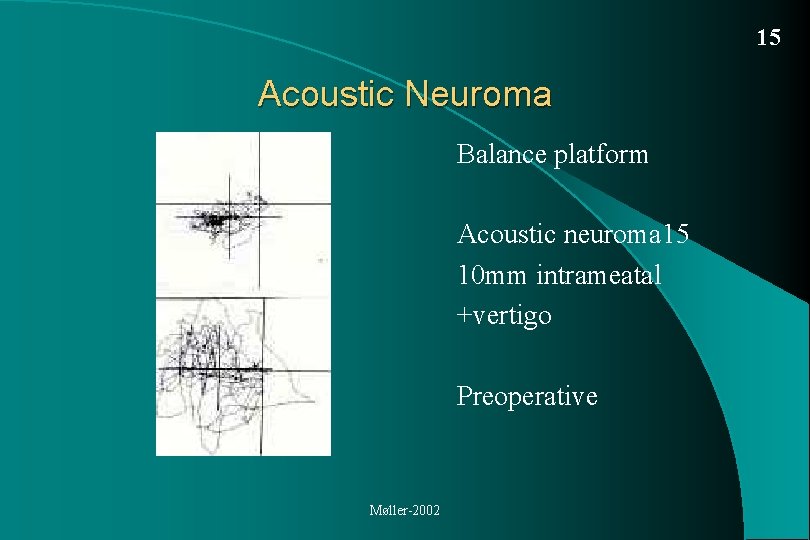 Acoustic Neuroma Vestibular Schwannoma Diagnosis and treatment Per
