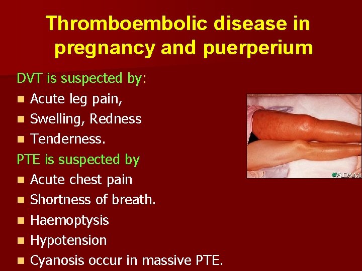 Venous complications in pregnancy and puerperium ASSOCIATE PROFESSOR