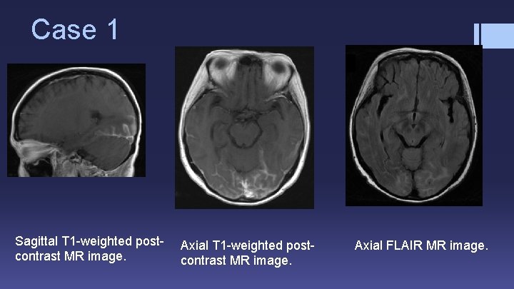 MR Imaging of PostTreatment Changes in the Brain