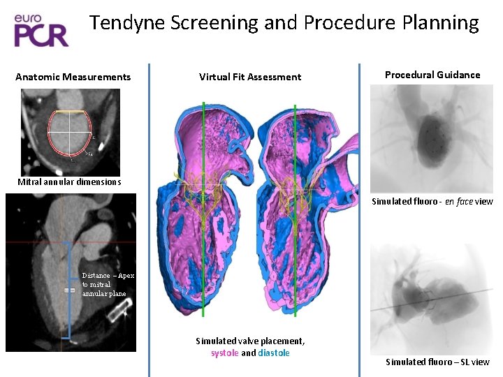 CE Mark Study of Transcatheter Mitral Valve Replacement