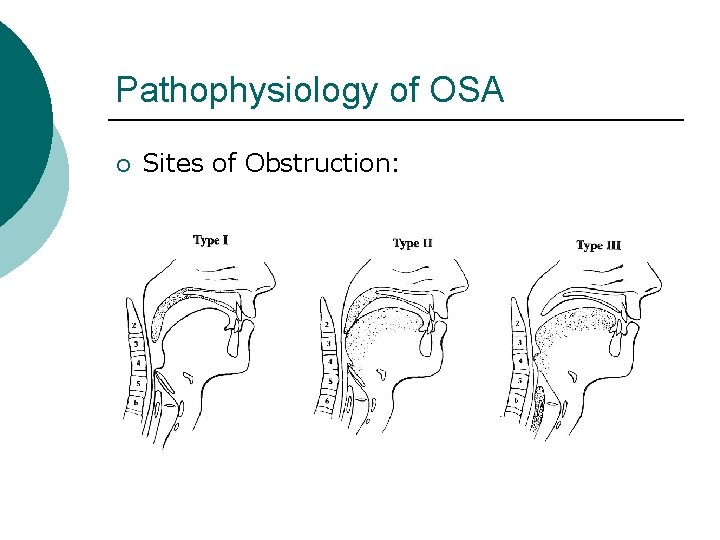 Obstructive Sleep Apnea Melanie Giesler DO Patient Evaluation