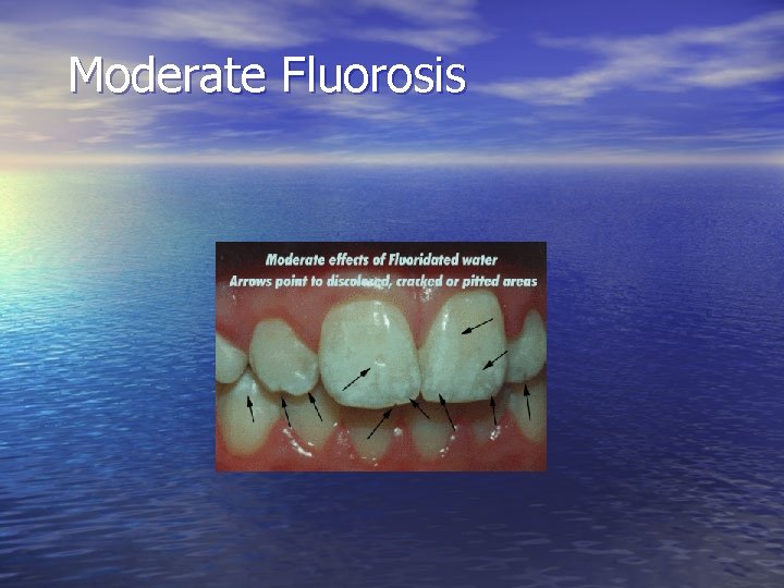 LEARNING OBJECTIVES Understand the biologic mechanism of fluoridation