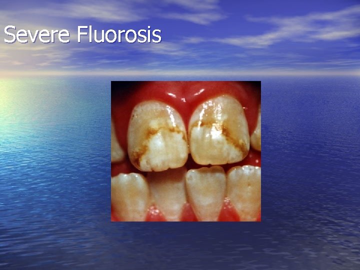 LEARNING OBJECTIVES Understand the biologic mechanism of fluoridation