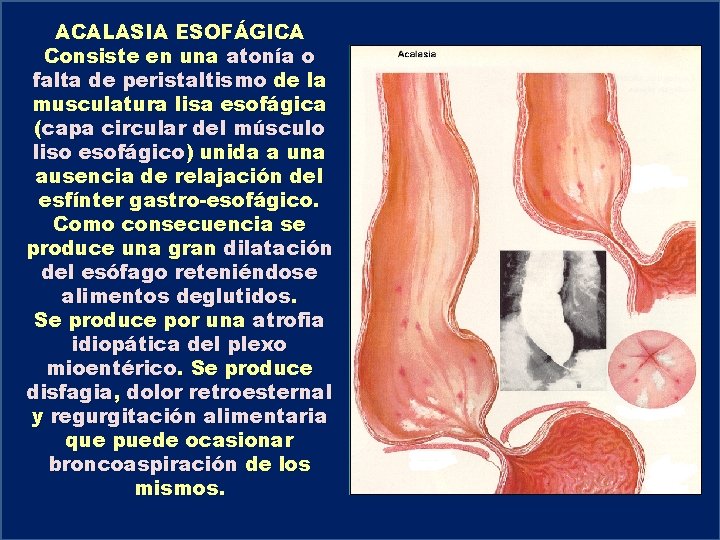 TRASTORNOS MOTORES DE LA DEGLUCIN Y DEL ESFAGO