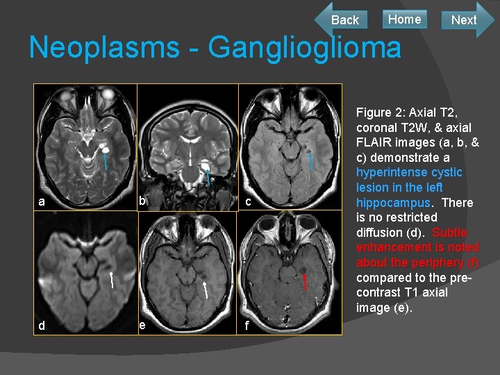 DECONVOLUTING CONVULSIONS AN MRIBASED REVIEW OF PEDIATRIC EPILEPSY