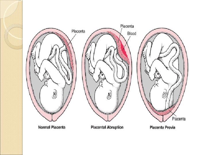 Antepartum haemorrhage antepartum haemorrhage APH also prepartum hemorrhage