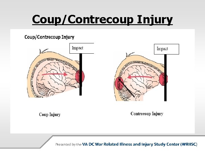 Traumatic Brain Injury Blast Versus NonBlast Trauma Julie