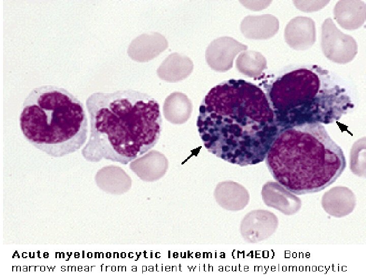 The acute Leukemias are clonal hematopoietic malignant disease