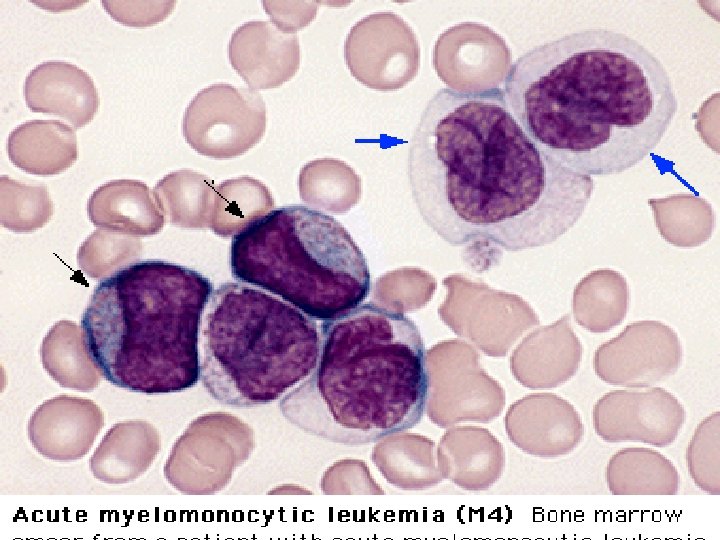 The acute Leukemias are clonal hematopoietic malignant disease