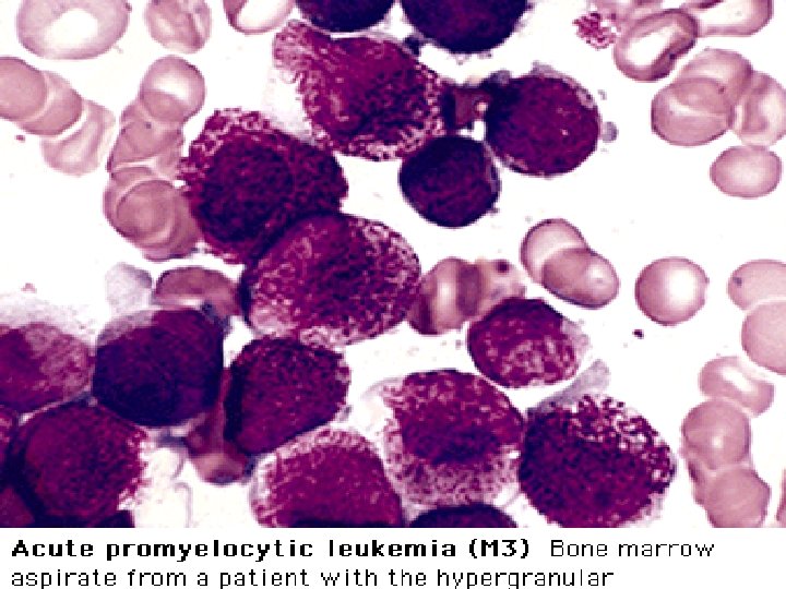 The acute Leukemias are clonal hematopoietic malignant disease