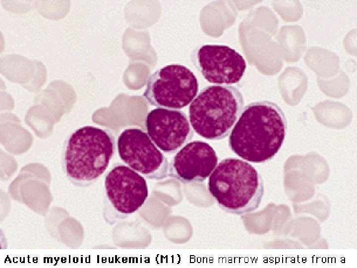 The acute Leukemias are clonal hematopoietic malignant disease