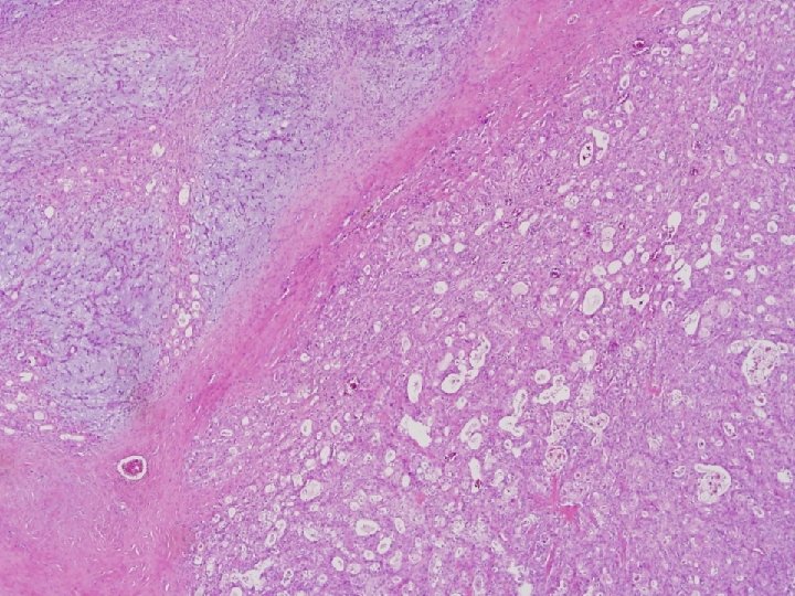 Wellmarginated heterogeneous enhancing mass 4 1 x 3