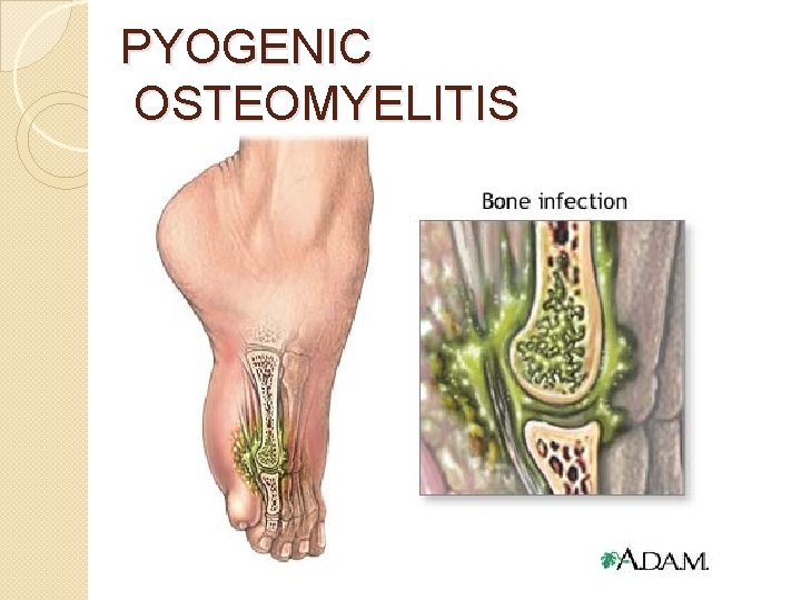 MUSCULOSKELETAL BLOCK Pathology Lecture 2 OSTEOMYELITIS and SEPTIC