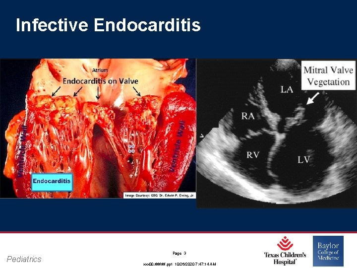 Endocarditis for the Advanced Practice Provider Julie K