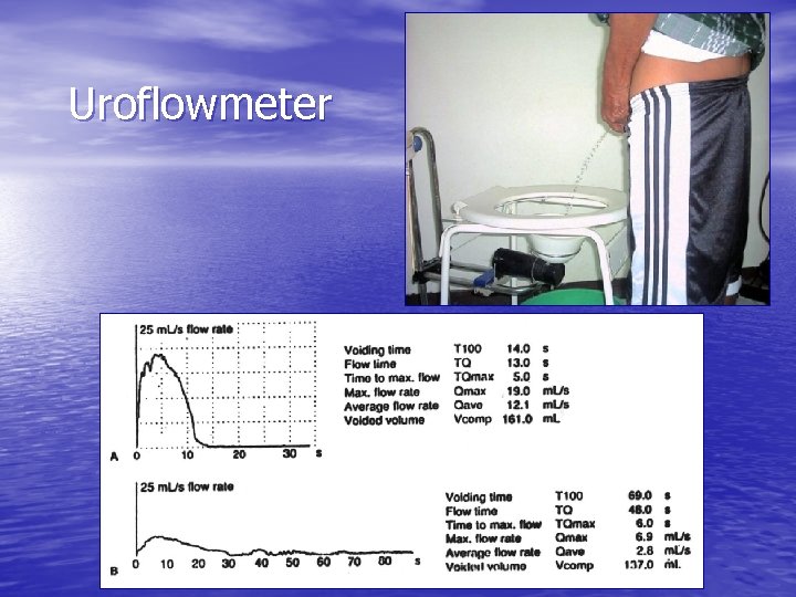 BPH Benign Prostate Hyperplasia sel bertambah banyak Neoplasma