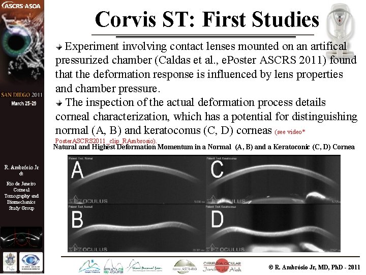 Corneal Biomechanical Assessment using Dynamic Ultra HighSpeed Scheimpflug