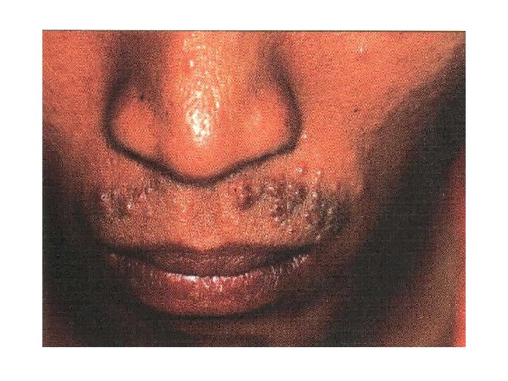 Manifestations cutanes du VIH paramdicaux hors tumeurs et