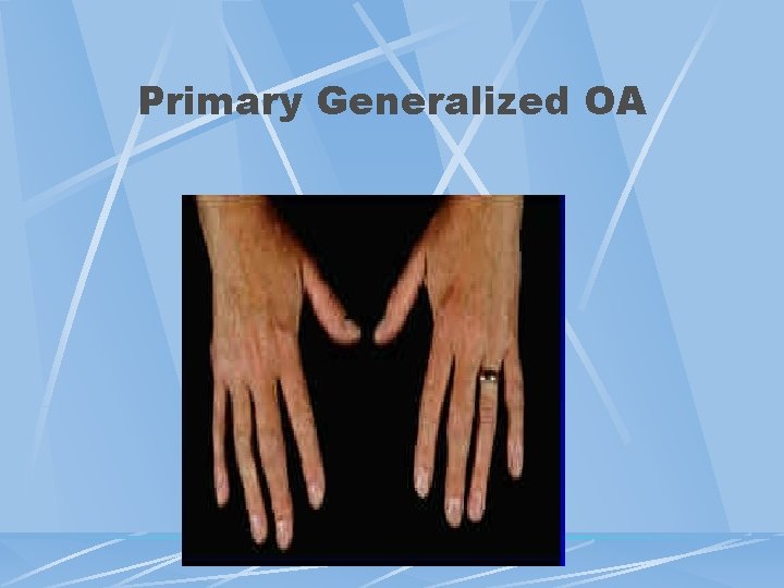 OSTEOARTHRITIS DEGENERATIVE JOINT DISEASE DEFINITION Osteoarthritis OA is