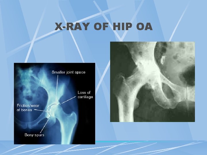 OSTEOARTHRITIS DEGENERATIVE JOINT DISEASE DEFINITION Osteoarthritis OA is