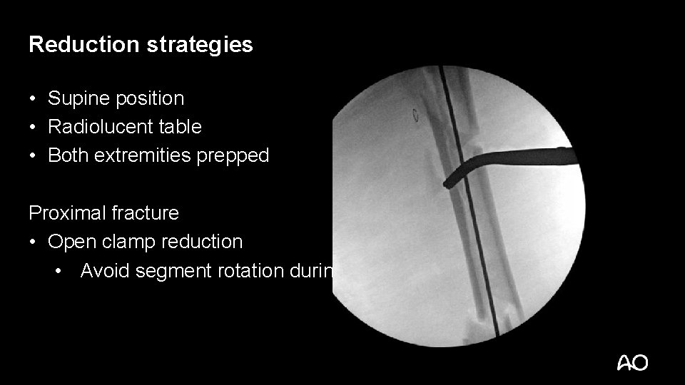 Complex femoral shaft fracture 1 Case for small
