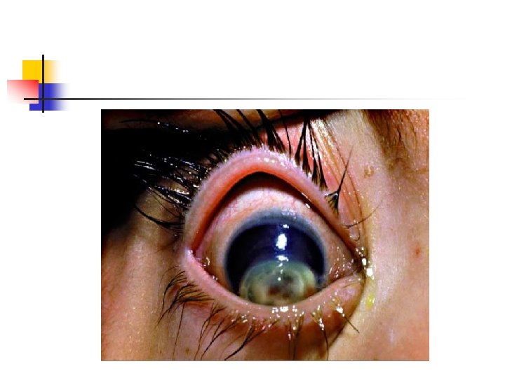 DISEASES OF THE CORNEA Dr Neeti Gupta Associate