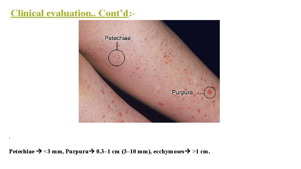 Approach to Bleeding Disorders Dr Arvind gupta Assistant