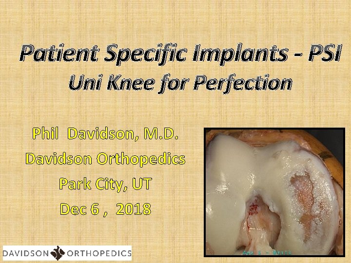 Patient Specific Implants PSI Uni Knee for Perfection