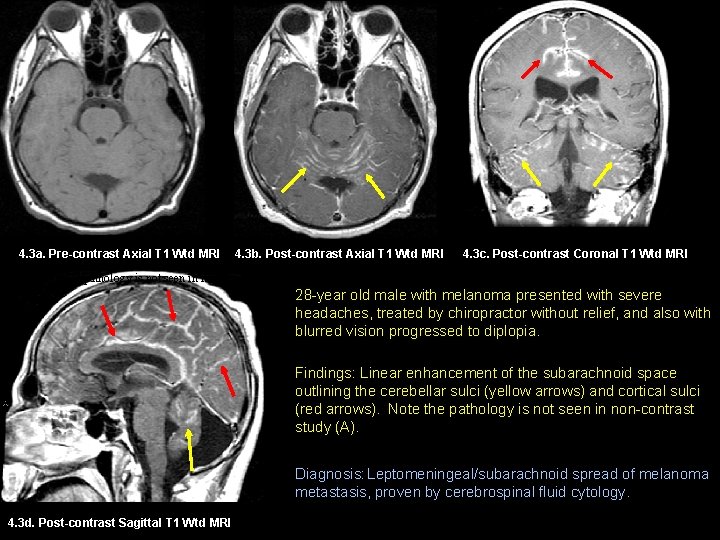4 1 a Axial T 2 Wtd MRI