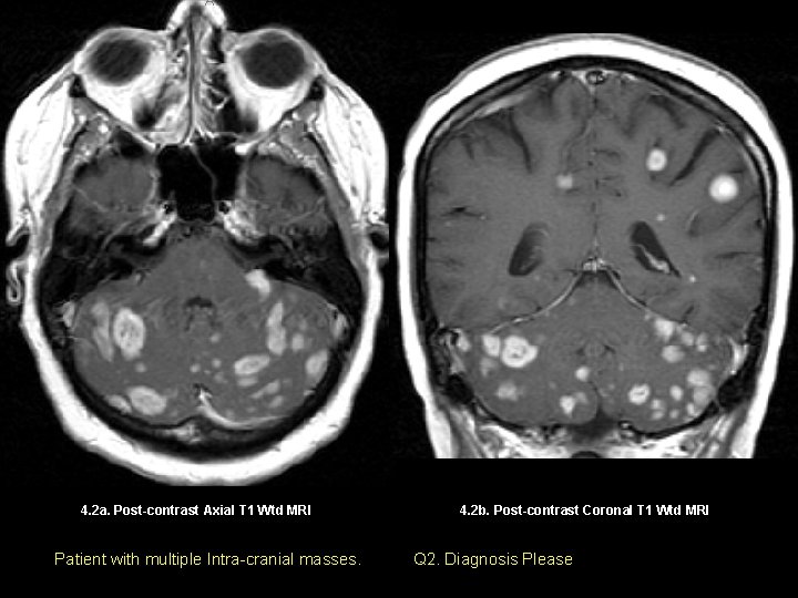 4 1 a Axial T 2 Wtd MRI