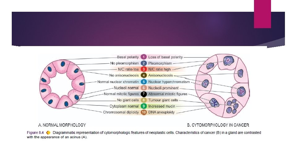 NEOPLASIA DIFFERENCE BETWEEN BENIGN MALIGNANT TUMORS ROUTES OF