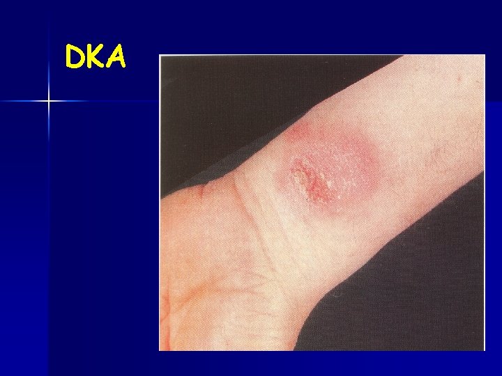 DERMATITIS by dr Rina Gustia Sp KK DERMATITIS