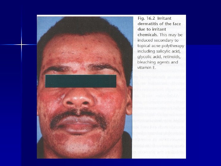 DERMATITIS by dr Rina Gustia Sp KK DERMATITIS