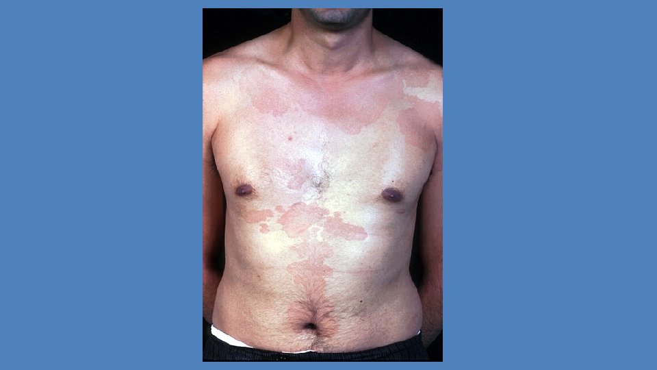 Diagnosis of superfacial and cutaneous mycoses Presented by