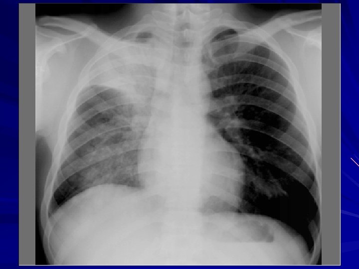 TUBERCULOSIS PULMONAR Incidencia TUBERCULOSIS PULMONAR Localizaciones ...