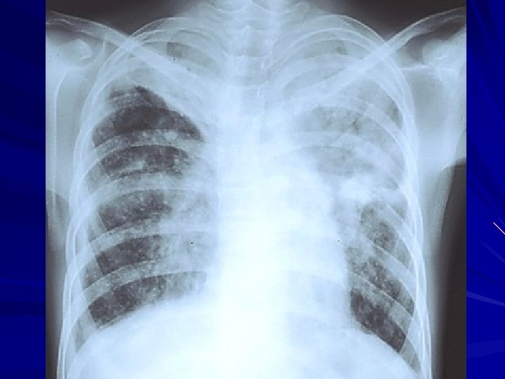 TUBERCULOSIS PULMONAR Incidencia TUBERCULOSIS PULMONAR Localizaciones ...