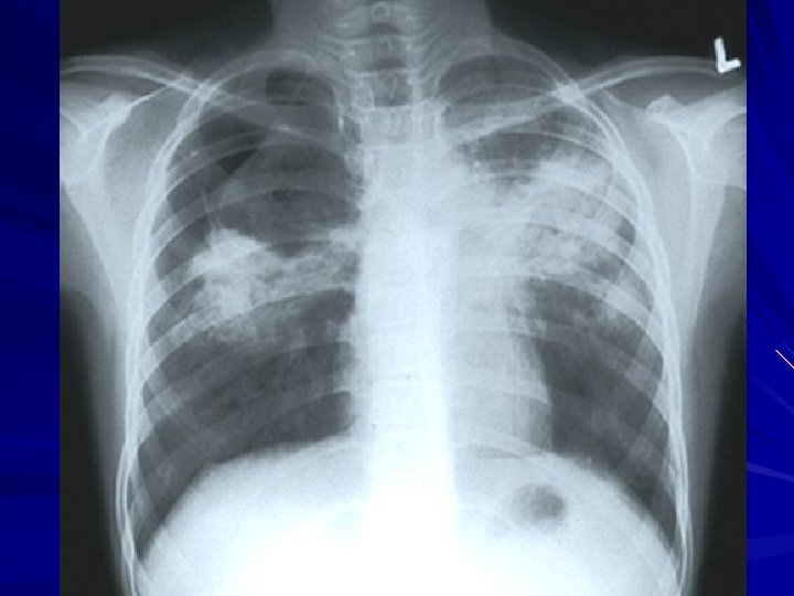 TUBERCULOSIS PULMONAR Incidencia TUBERCULOSIS PULMONAR Localizaciones ...