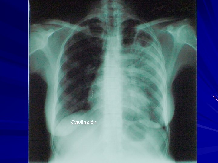 TUBERCULOSIS PULMONAR Incidencia TUBERCULOSIS PULMONAR Localizaciones ...