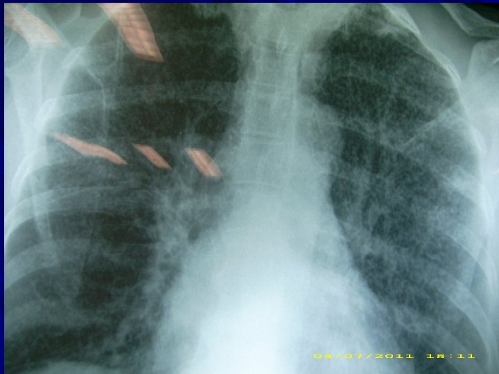 TUBERCULOSIS PULMONAR Incidencia TUBERCULOSIS PULMONAR Localizaciones ...