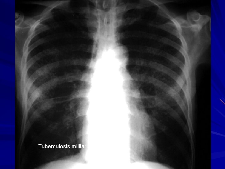 TUBERCULOSIS PULMONAR Incidencia TUBERCULOSIS PULMONAR Localizaciones ...