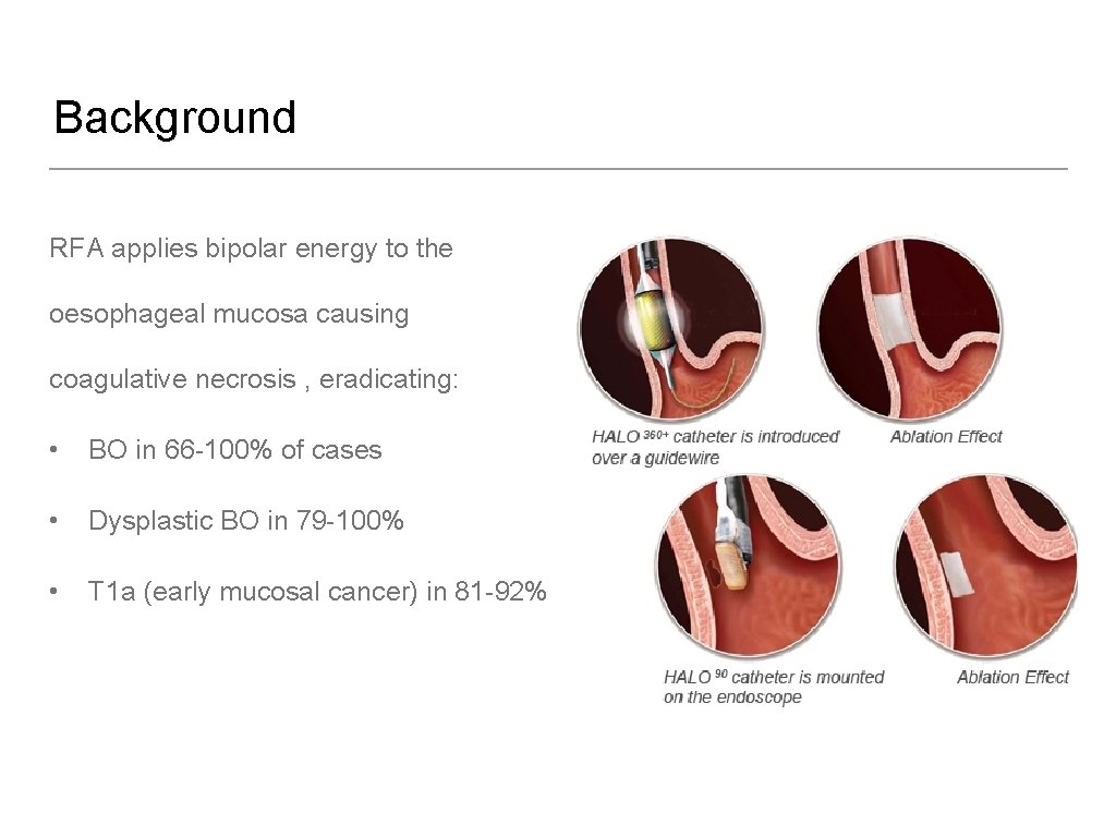 Radiofrequency ablation HALO in the treatment of Oesophageal
