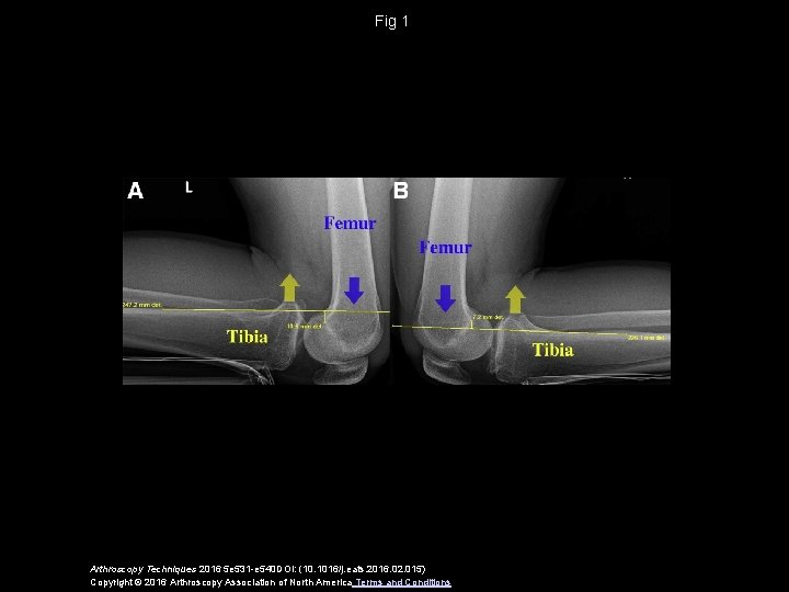 Anterolateral Biplanar Proximal Tibial OpeningWedge Osteotomy Chase S