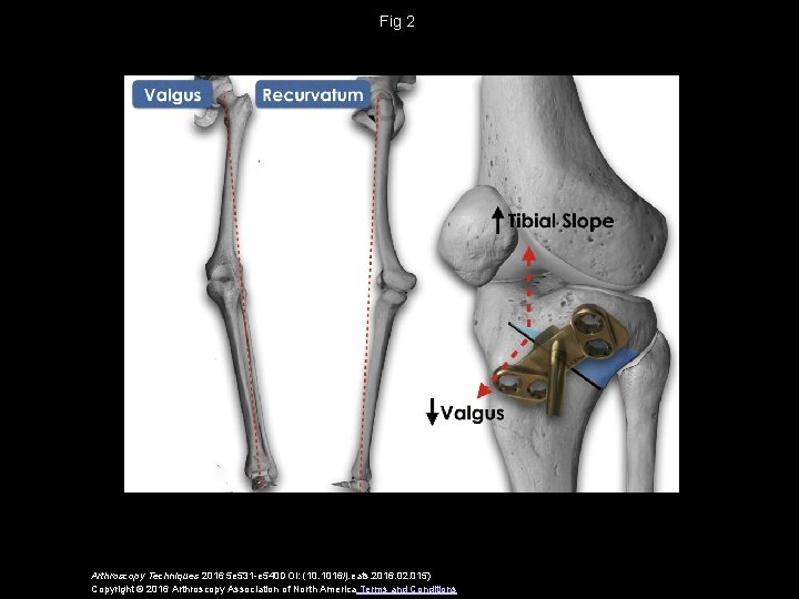 Anterolateral Biplanar Proximal Tibial OpeningWedge Osteotomy Chase S