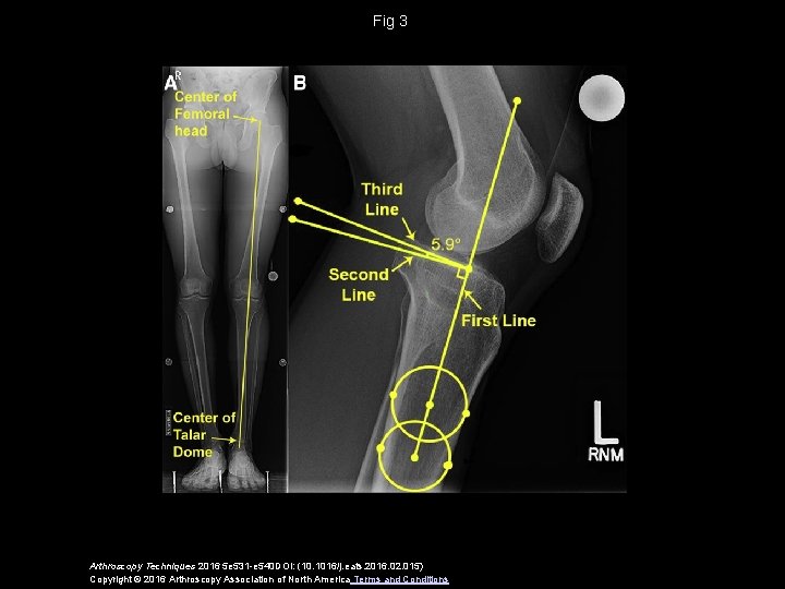 Anterolateral Biplanar Proximal Tibial OpeningWedge Osteotomy Chase S