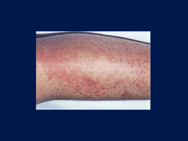 APPROACH TO PERIODIC FEVER SYNDROMES Sarah S Long