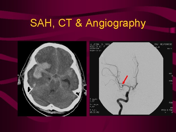 Subarachnoid Hemorrhage An Annual incidence In total population