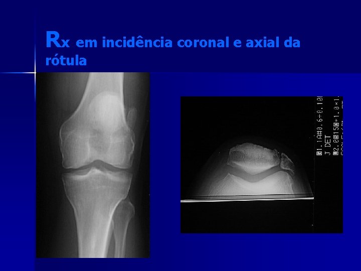IMAGIOLOGIA NAS LESES DO JOELHO DO ATLETA IMAGIOLOGIA