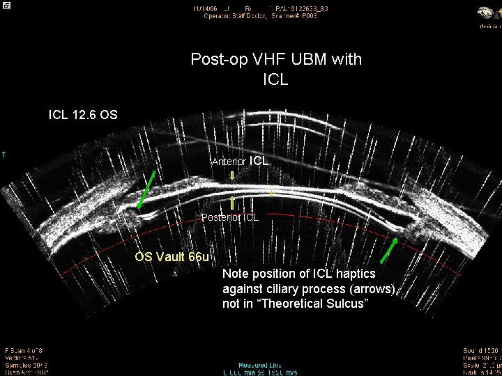 Artemistm II VHF Ultrasound for Sizing the Visian