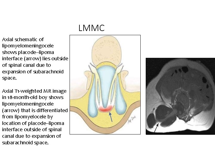 Spinal dysraphism Dr Demet Demirciolu Formation and separation