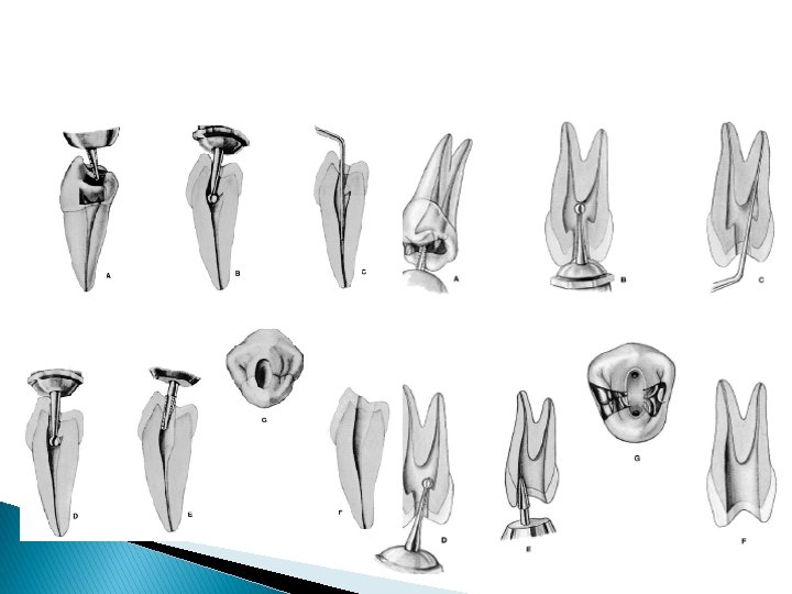 ROOT CANAL ANATOMY AND ACCESS CAVITY PREPERATION Dr
